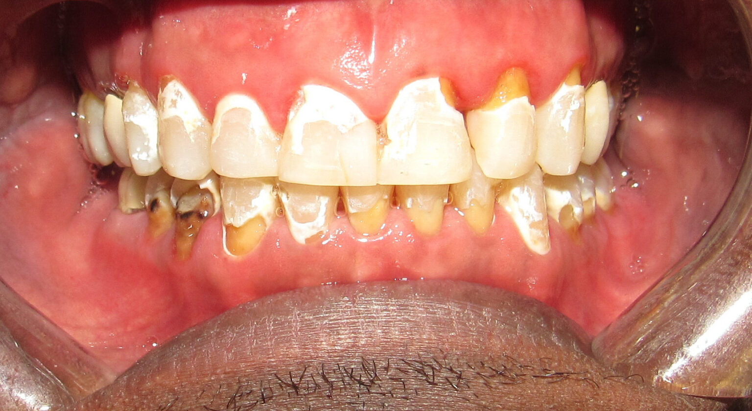 Can You Get Braces with Cavities? | Connolly Orthodontics in Ballantyne ...
